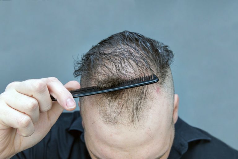 En savoir plus sur les greffes des cheveux